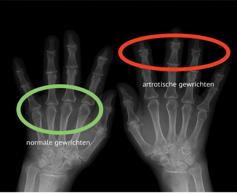 Vinger Artrose | HandsOnCare Klinieken