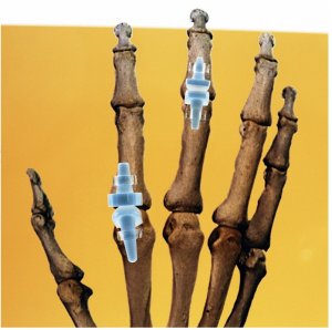 Vinger Artrose | HandsOnCare Klinieken