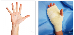 Triggervinger - HandsOnCare