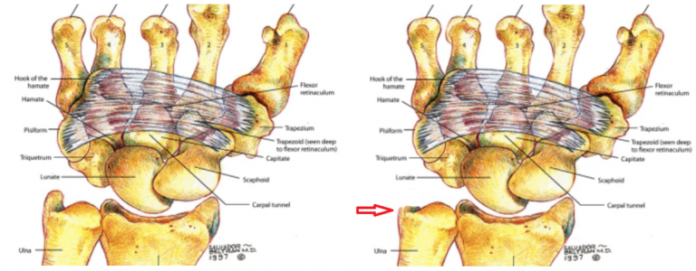 Ulnar Sided Wrist Pain | HandsOnCare Klinieken